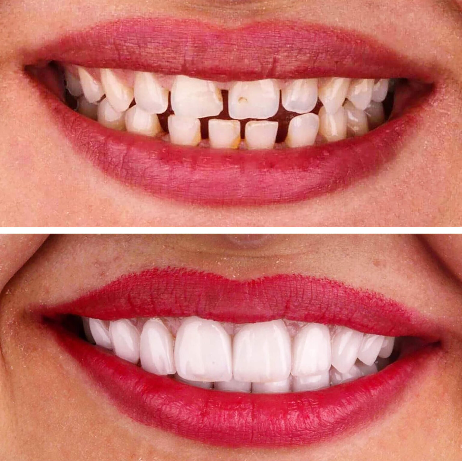 What Are Veneers: Types, Benefits, Procedures & Results
